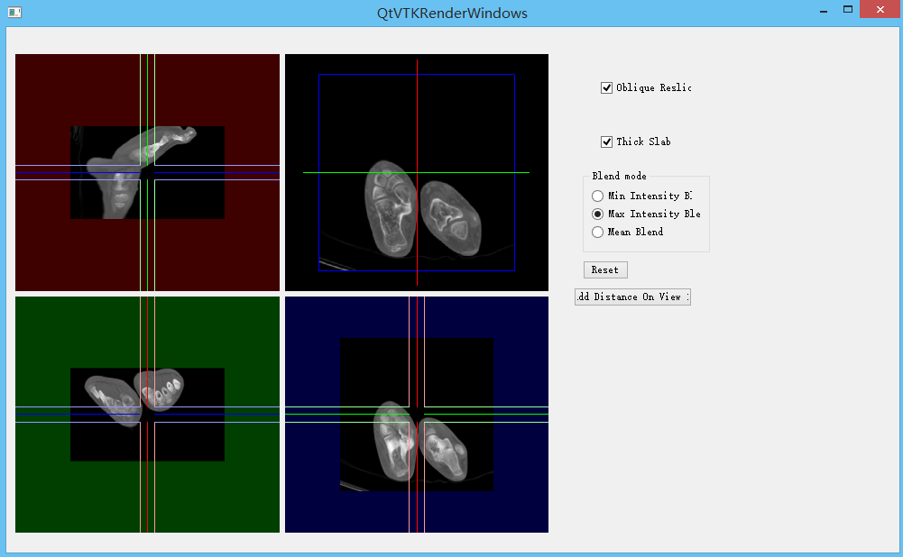 VTK Examples中MIP和MPR的功能实现与源码分析_vtk mip-CSDN博客